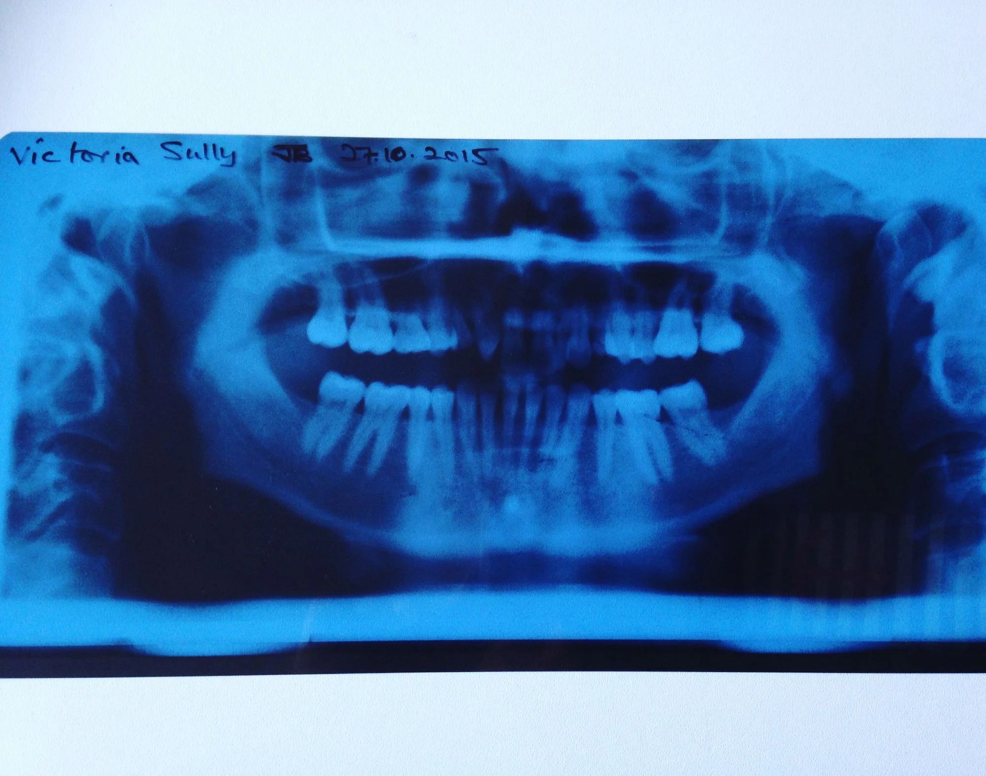 Getting Adult Braces at 30: My Complete Story & Photos