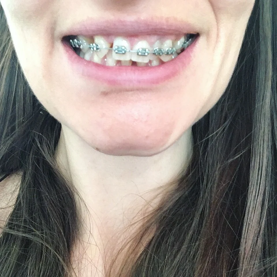 Getting Adult Braces at 30: My Complete Story & Photos