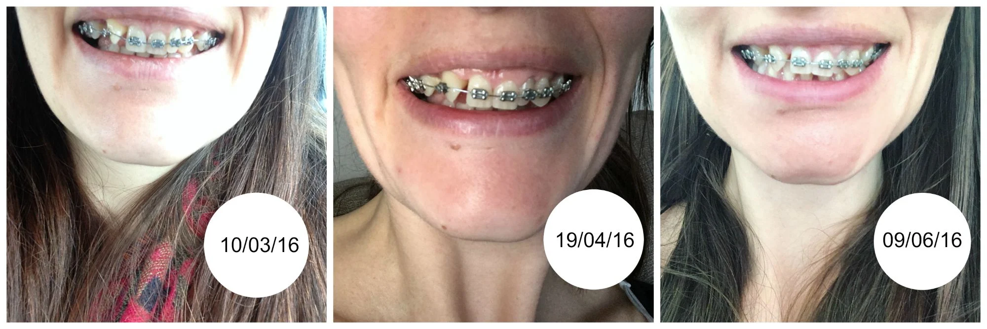 Getting Adult Braces at 30: My Complete Story & Photos