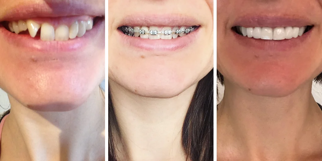 Getting Adult Braces at 30: My Complete Story & Photos